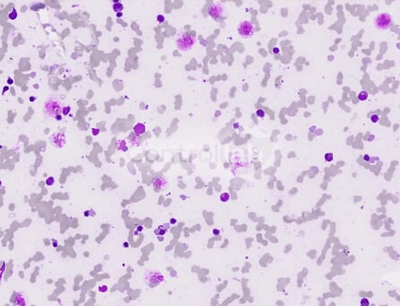 Biópsia de Medula Óssea – Controllab